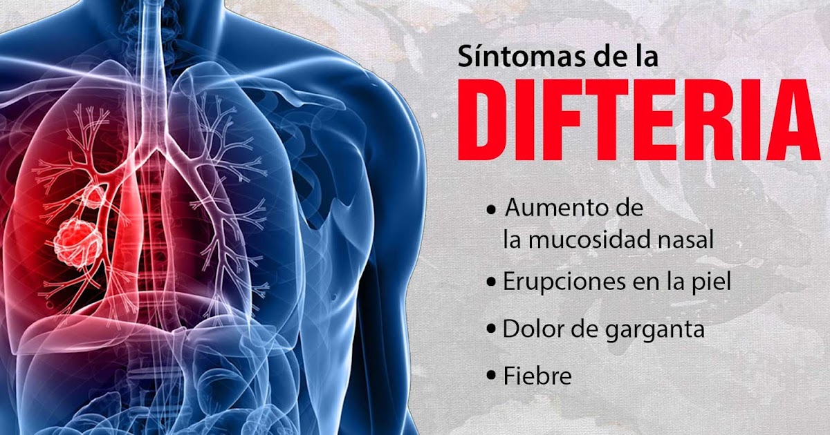 Salud reporta un caso de difteria en niño 4 años traído desde Haití