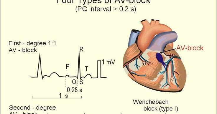 Medical and Health Science: types of AV-Block!!!