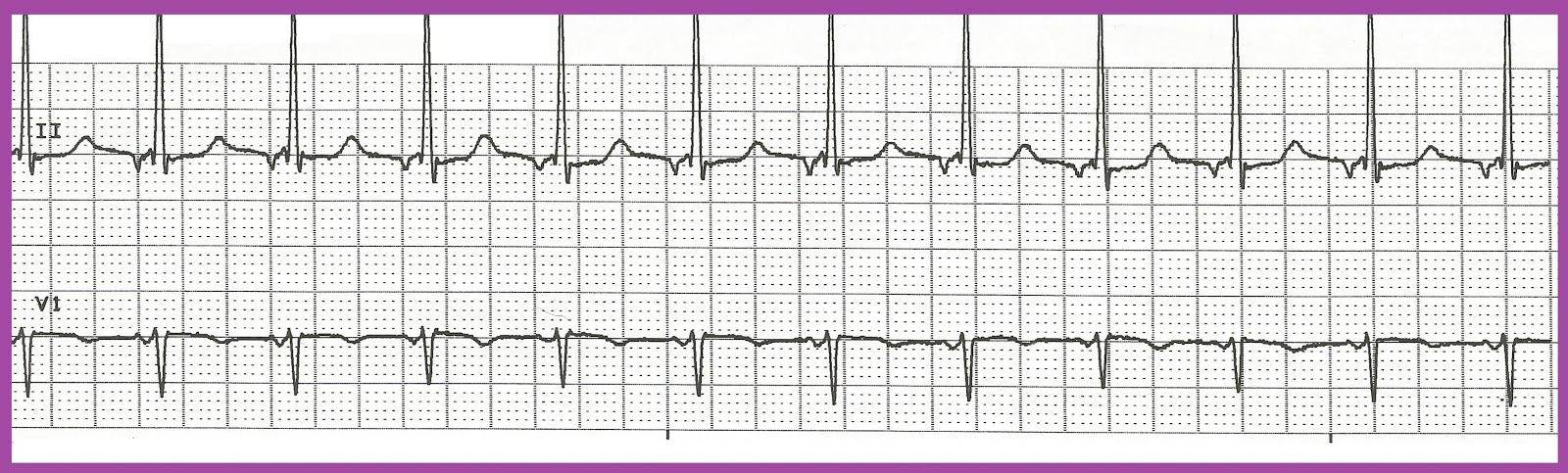 Characteristics of Junctional Rhythms