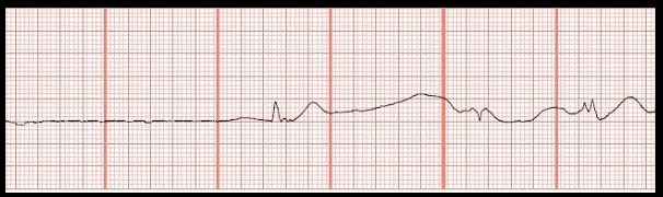 ECG Rhythm Strip Quiz 103