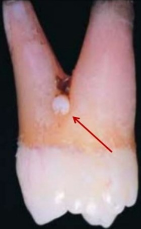 Tooth Enamel- Composition, Properties, Structure and Functions