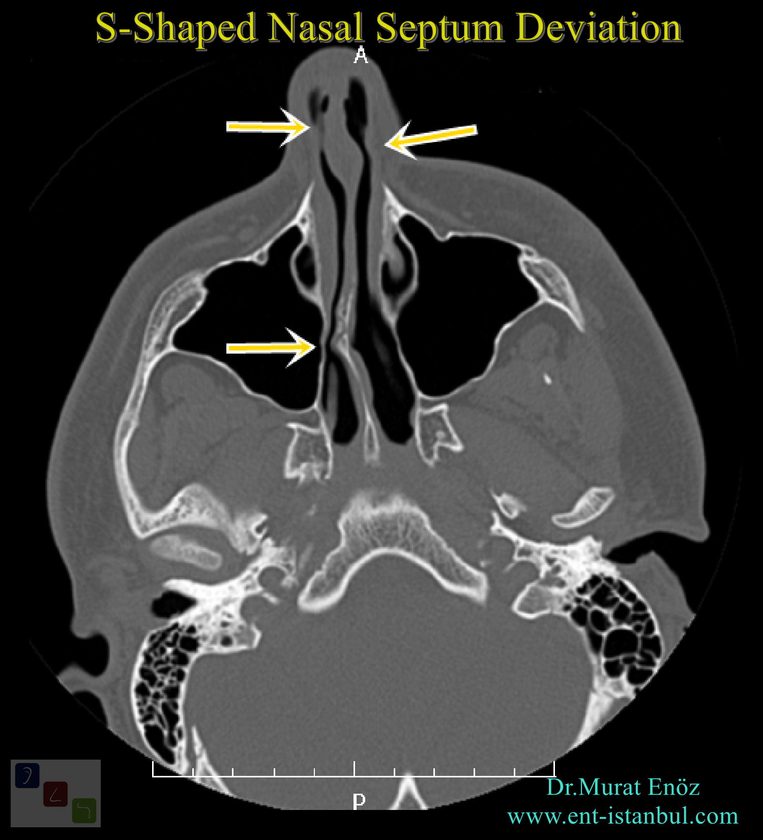Nasal Septum