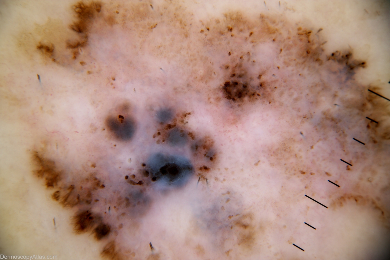 Dermoscopy Features as Clues: Clods Blue