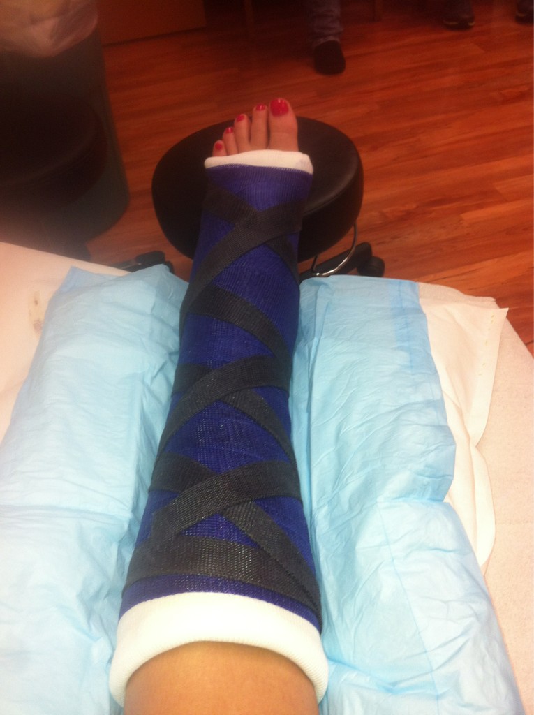 Casts and Toes: Some Short Leg Cast Pics
