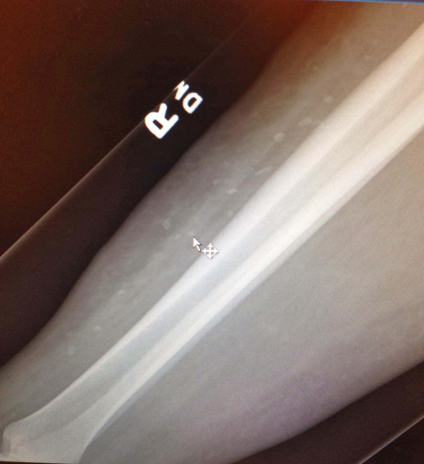 Calcification In Dialysis Patients