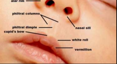 Cleft Lift and Palate
