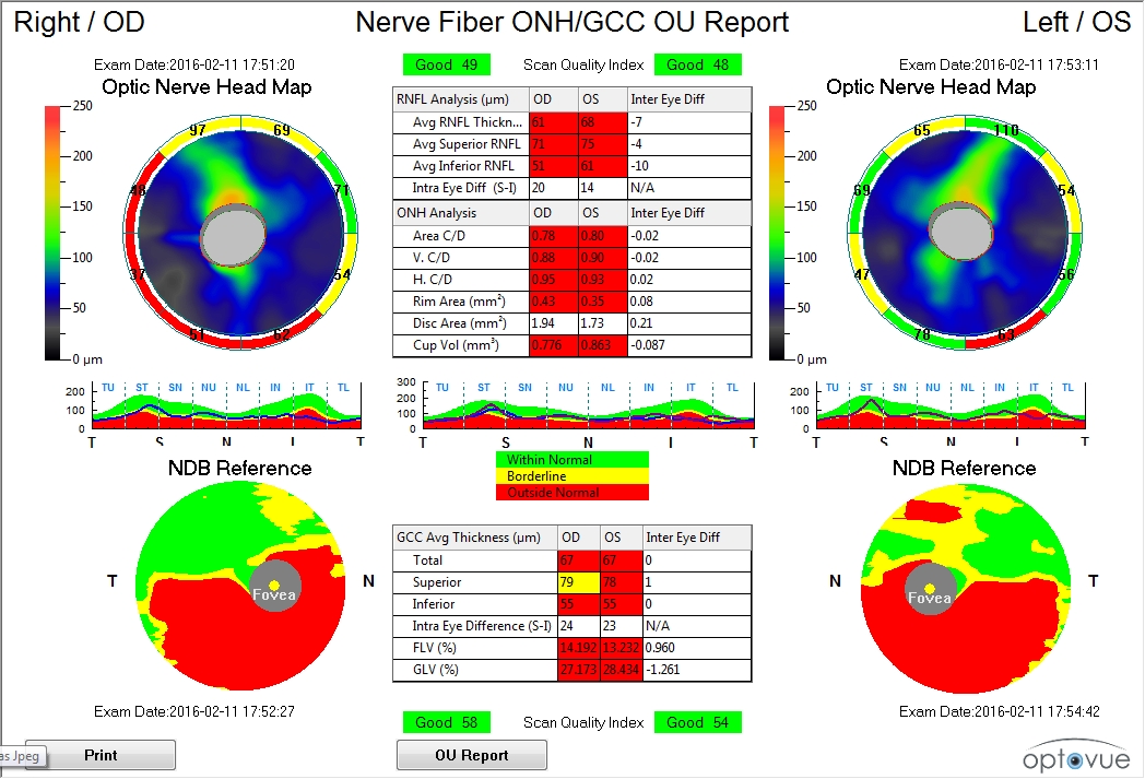 OCT IN GLAUCOMA | Sonoran Desert Eye Center