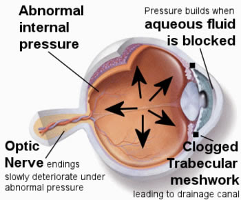 Glaucoma Therapy, Selective Laser Trabeculoplasty (SLT)
