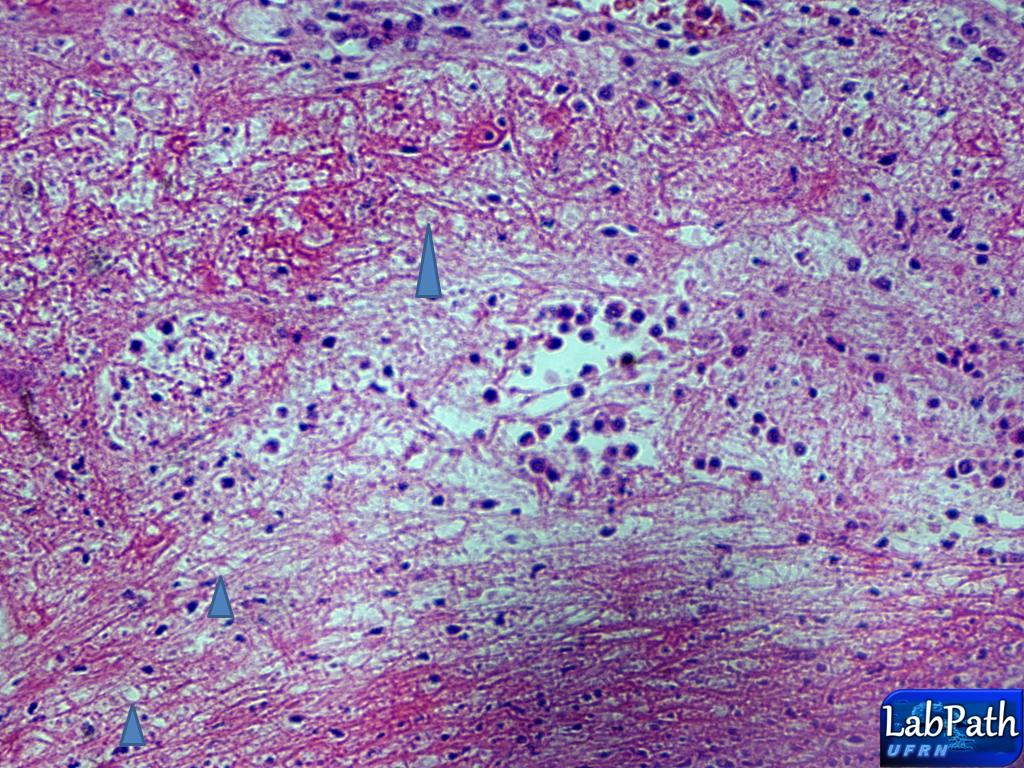 LAICI - Laboratório de Investigação de Câncer e Inflamação: Êmbolo séptico