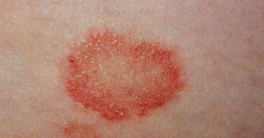 Bawang: Home Remedy Para sa Buni | Pinoy Health Tips