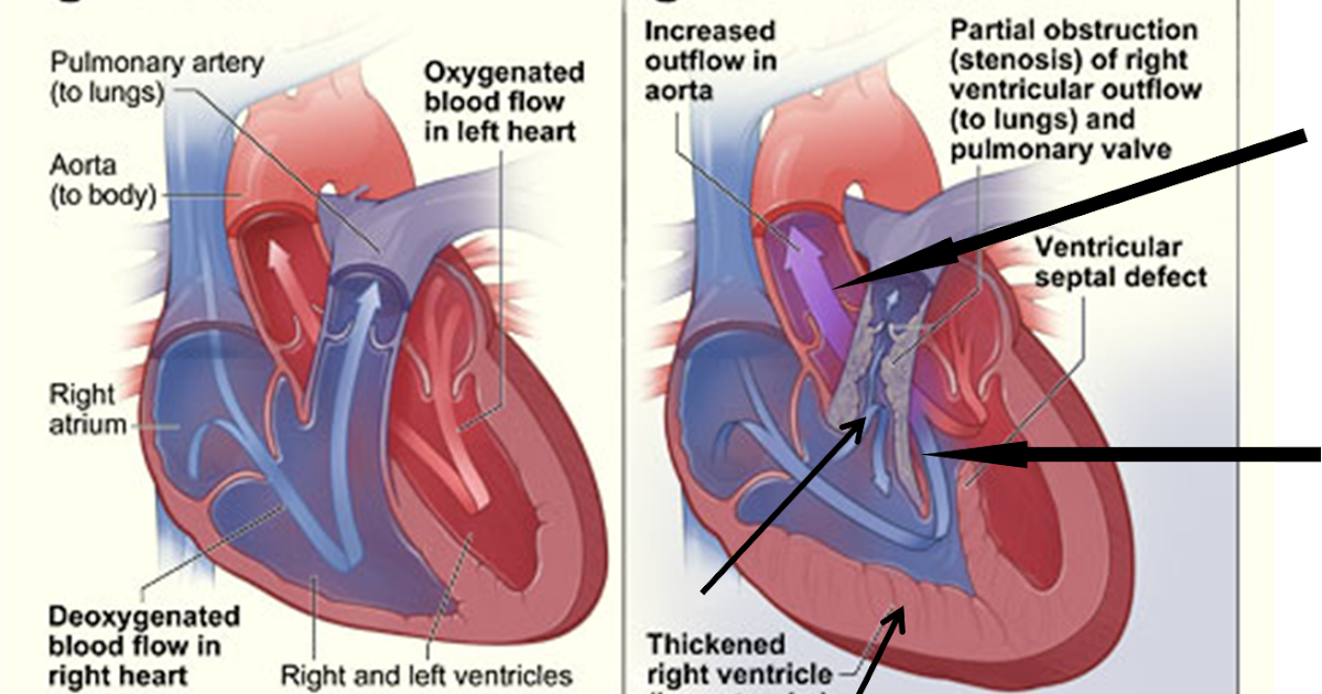 die Aerztin: MAKALAH TOF (TETRALOGY OF FALLOT) - KOAS KARDIOLOGI