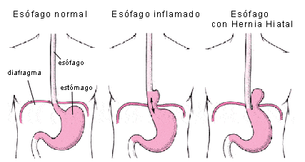 Esofagitis por reflujo gastroesofágico Sintomas y Tratamientos | Salud ...