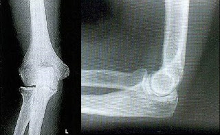 Estudo Radiográfico : ROTINA DE COTOVELO