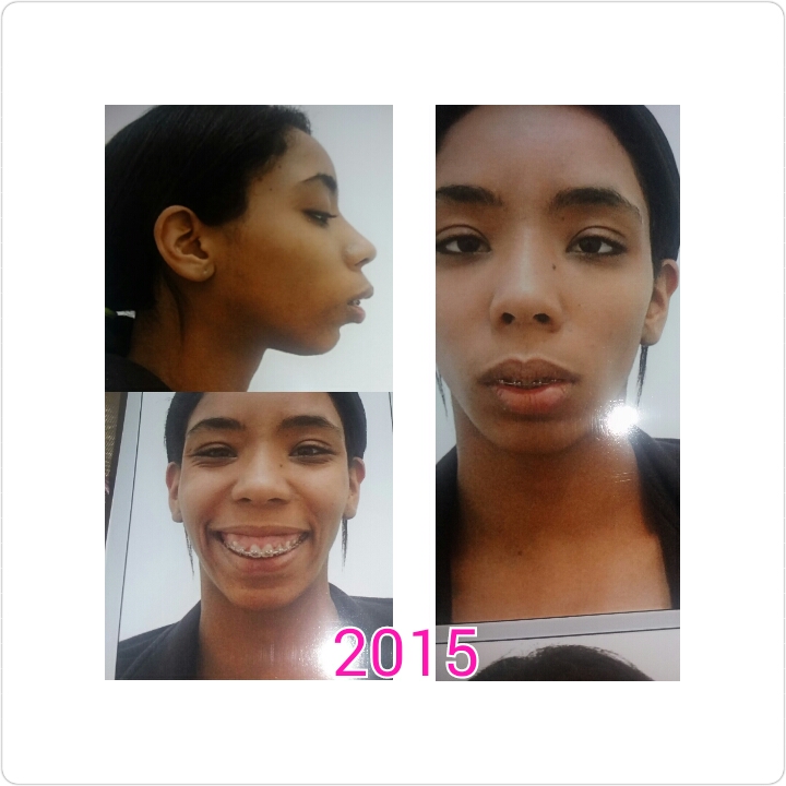 Diário de um Sonho, Cirurgia Ortognática !!: 11anos : Retrognátismo