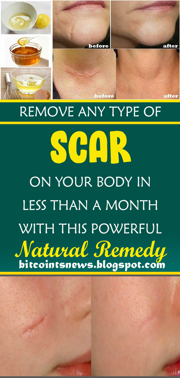 REMOVE ANY TYPE OF SCAR ON YOUR BODY IN LESS THAN A MONTH WITH THIS ...