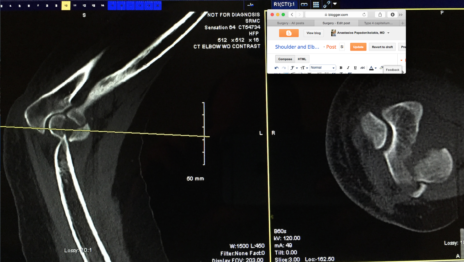 Shoulder and Elbow Surgery: Shear fractures of the capitellum.