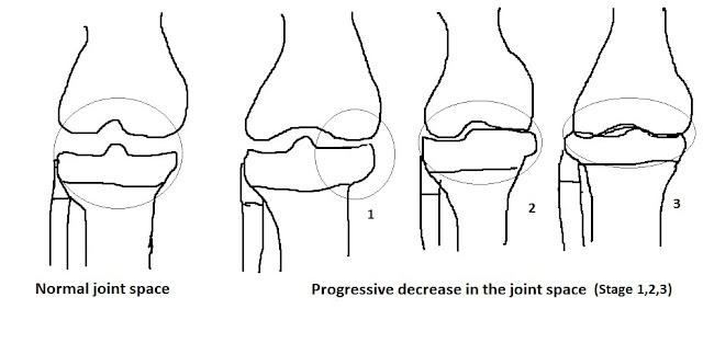 Medical suggestions: Knee joint osteoarthritis