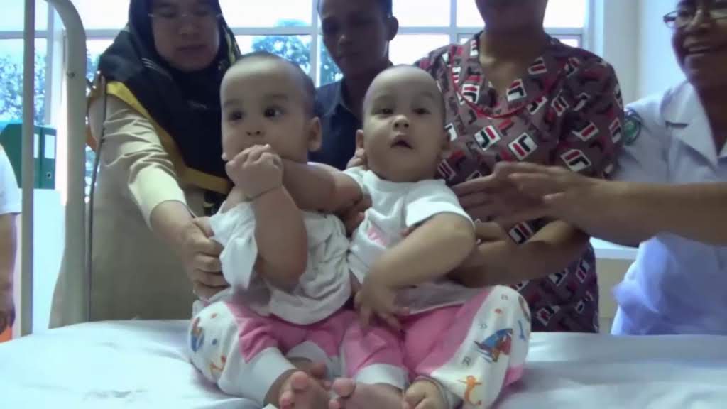 Bayi Kembar Siam Asal Taput Akan Segera di Operasi, RSU Adam Malik Medan Telah Bentuk Tim Dokter ...