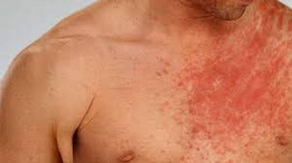 What Are the Causes And Symptoms of Cutaneous Candidiasis? | Skin ...