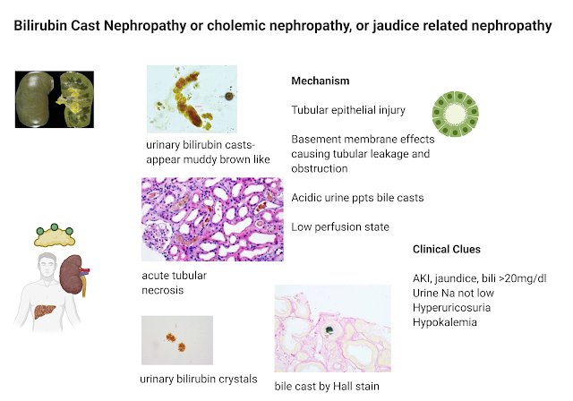 Nephron Power: Discussion via pics: Bile Cast Nephropathy