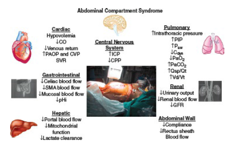 Abdominal Compartment Syndrome