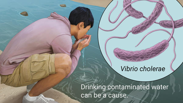 Cholera: Signs and Symptoms Of Cholera - Medical Yukti