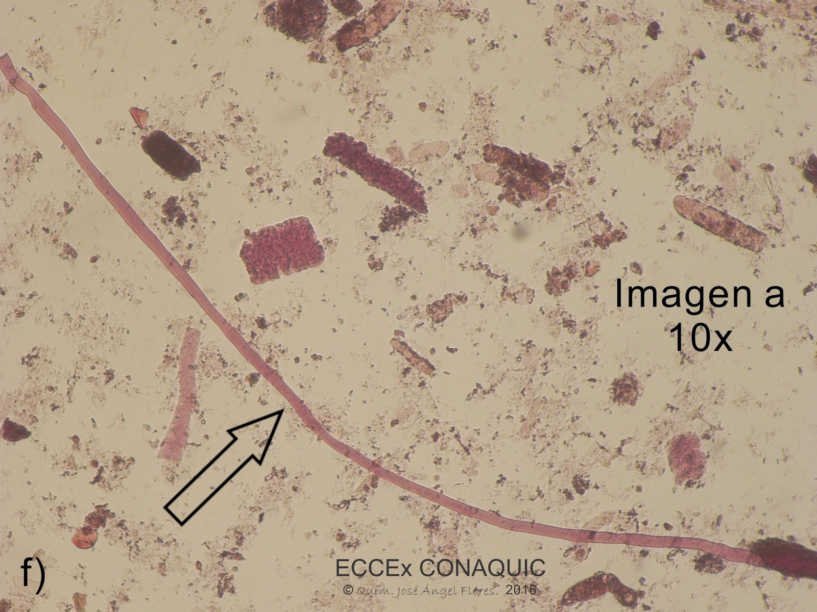 Caso UR-marzo-16 (Enfoque: cilindruria)
