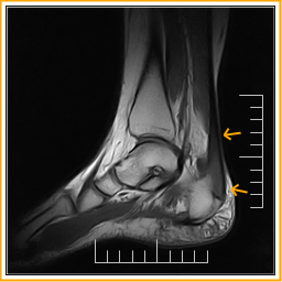 Insertional Tendinopathy of Achilles Tendon - Sumer's Radiology Blog