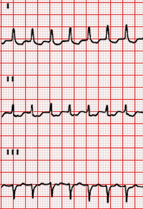 Prehospital Wisdom I Hate Adenosine prehospital-wisdom-i-hate-adenosine