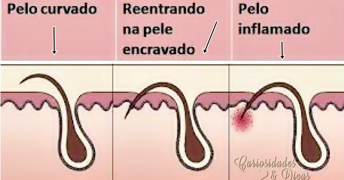 Curiosidades e dicas: Como tratar os pêlos encravados