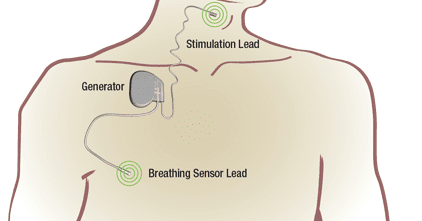 Criteria for INSPIRE Pacemaker to Treat Obstructive Sleep Apnea (OSA ...