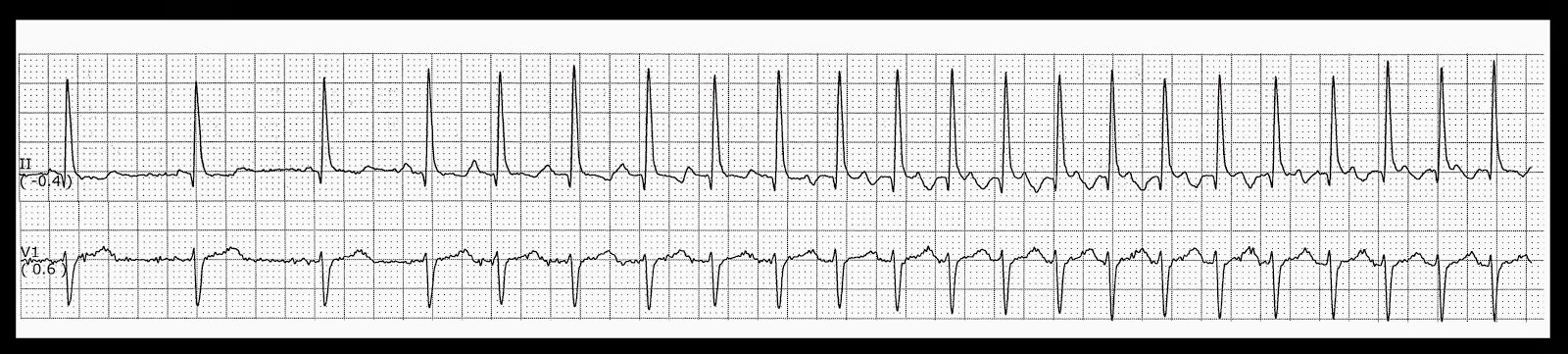 Basic EKG Rhythm Test 15
