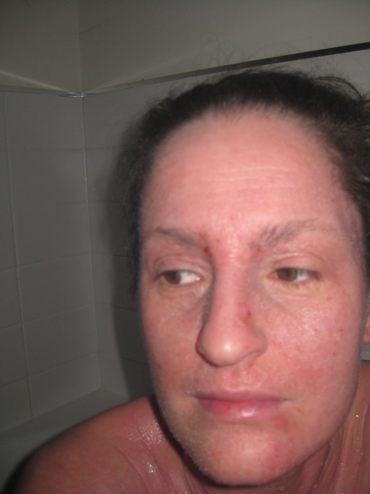 Topical Steroid Withdrawal Journey-Healing Eczema and Red Skin Syndrome ...