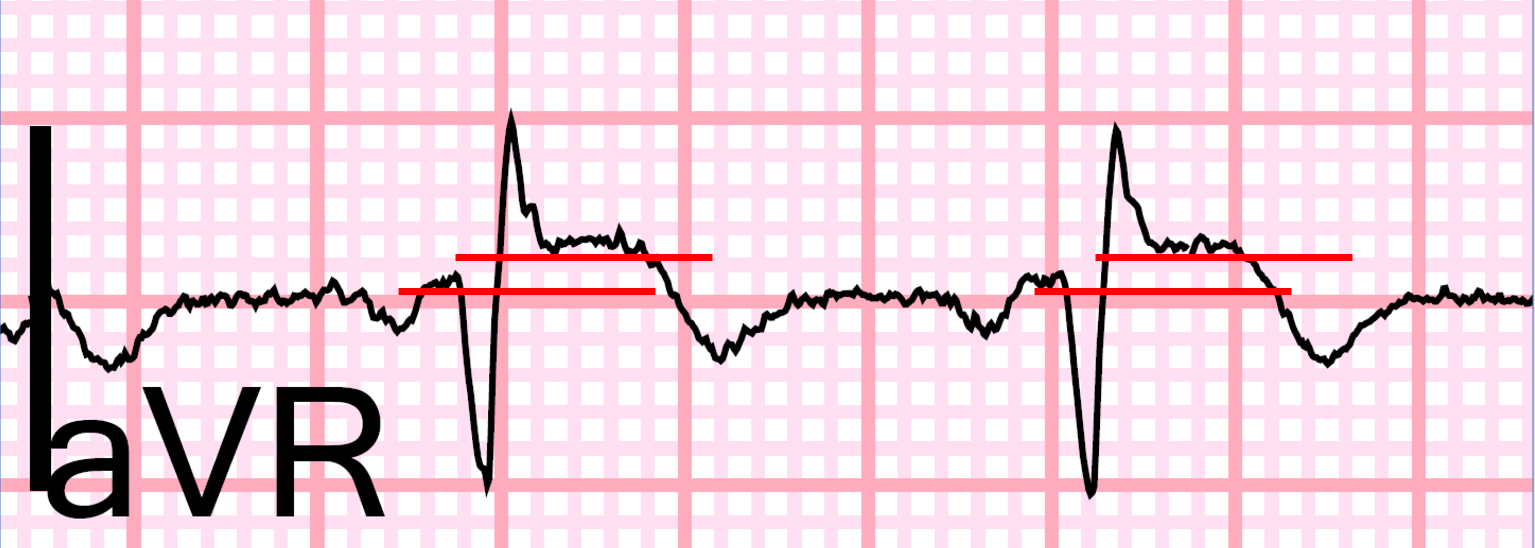 Dr. Smith's ECG Blog: April 2020