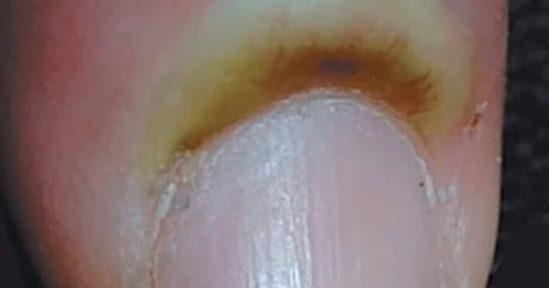 Le panaris ~ Soins infirmiers En France