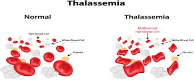 Thalassemia: Types, Causes, Symptoms and Treatment - Health4all