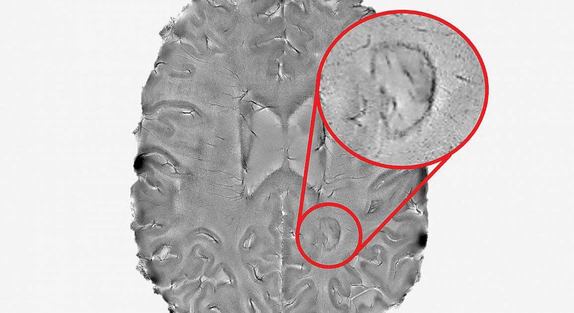 Esclerosis-Multiple-MSblog: Lesiones con Borde Paramagnético y su ...