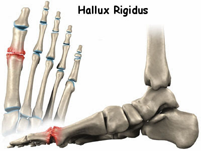 MYO Therapy & Healthcare Institute: Hallux Rigidus Symptoms(Stiff Big Toe)
