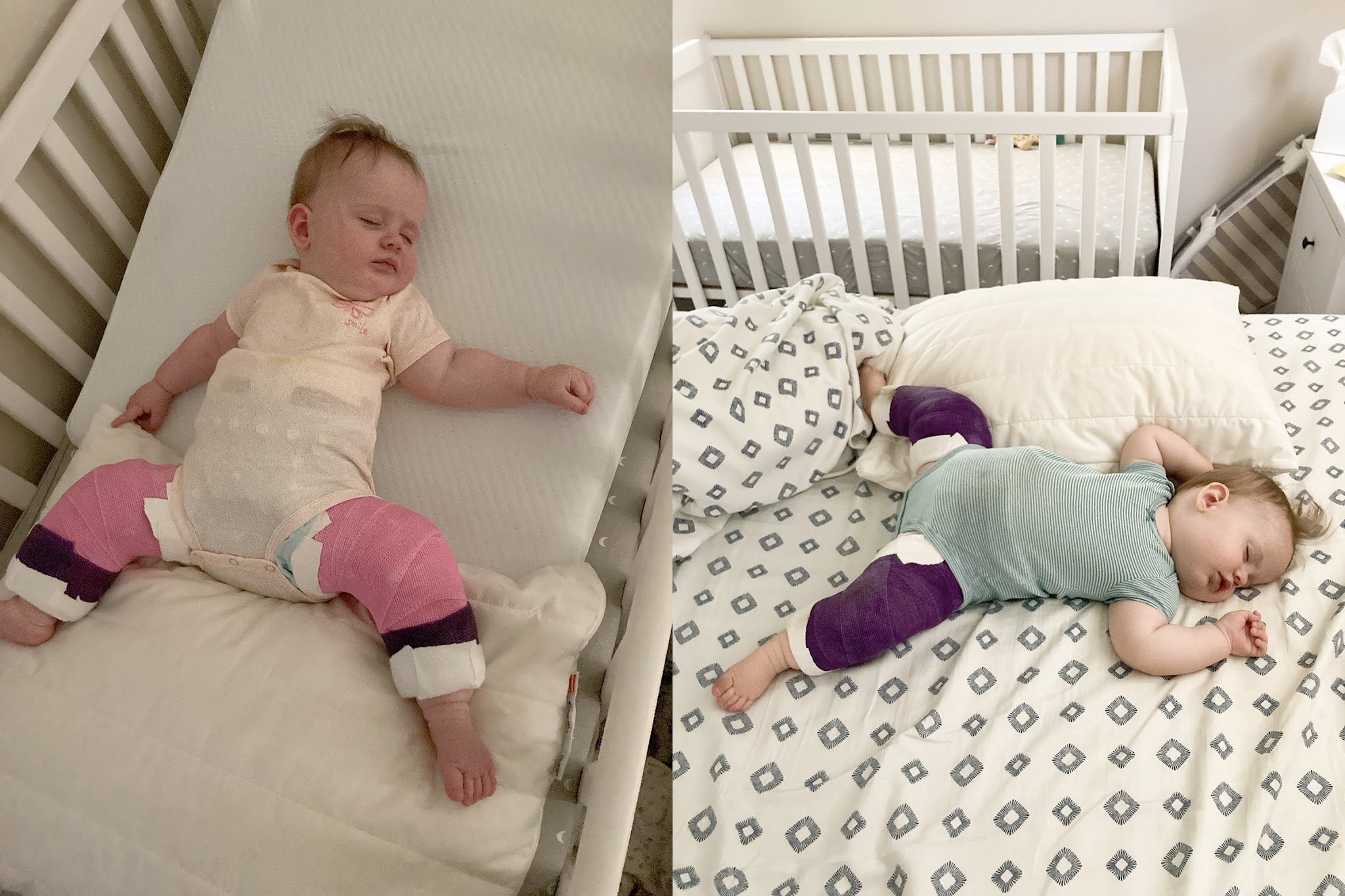 How to Survive (and Thrive!) with a Hip Spica Cast - The Baker Upstairs