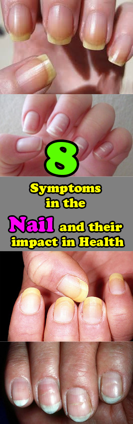 8 Symptoms In The Nails And Their Impact In Health