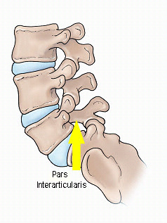 Spondylolysis or Pars Fracture | Growing Spine Blog | Washington ...