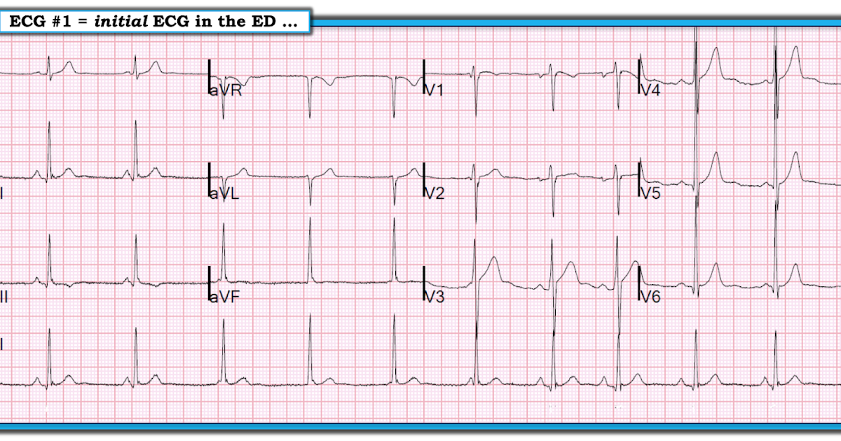 ECG Interpretation: ECG Blog #160 (AV Block - AV Dissociation ...