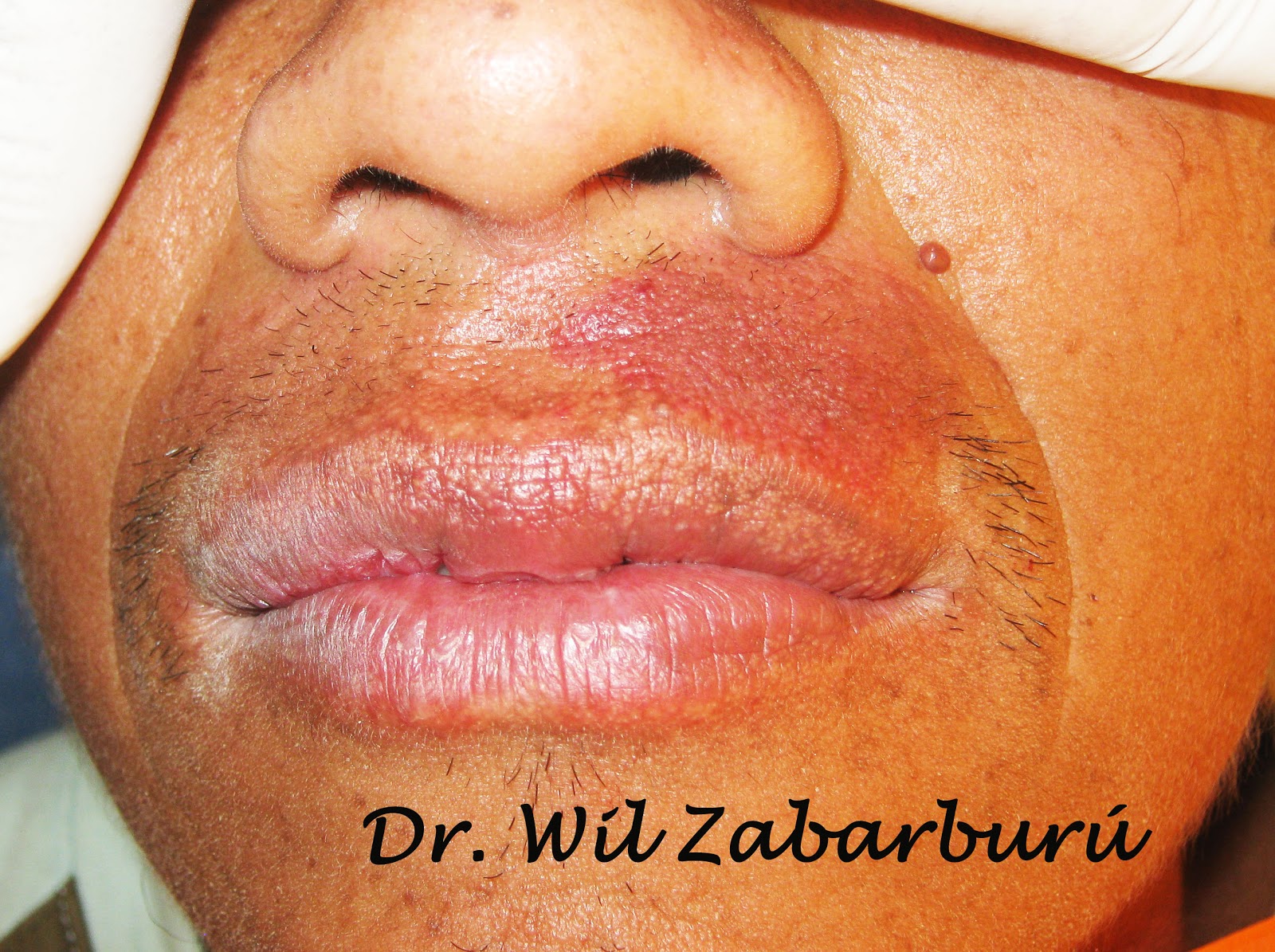 CLINICA DENTAL ASISTENCIAL: NEVUS FLAMMEUS