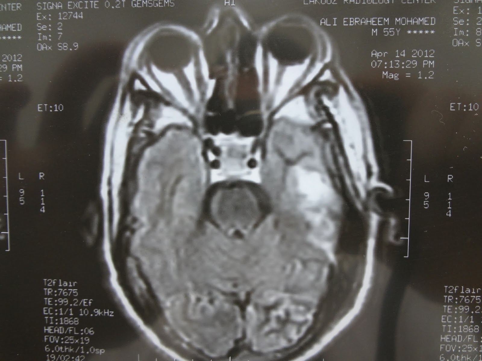 lt temporal lobe abscess complicating attico antral cholesteatoma MRI ...