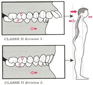 APARATOLOGIA ORTOPEDICA: DEFINICIÓN DE LA ORTOPEDIA, MALOCLUSIONES ...