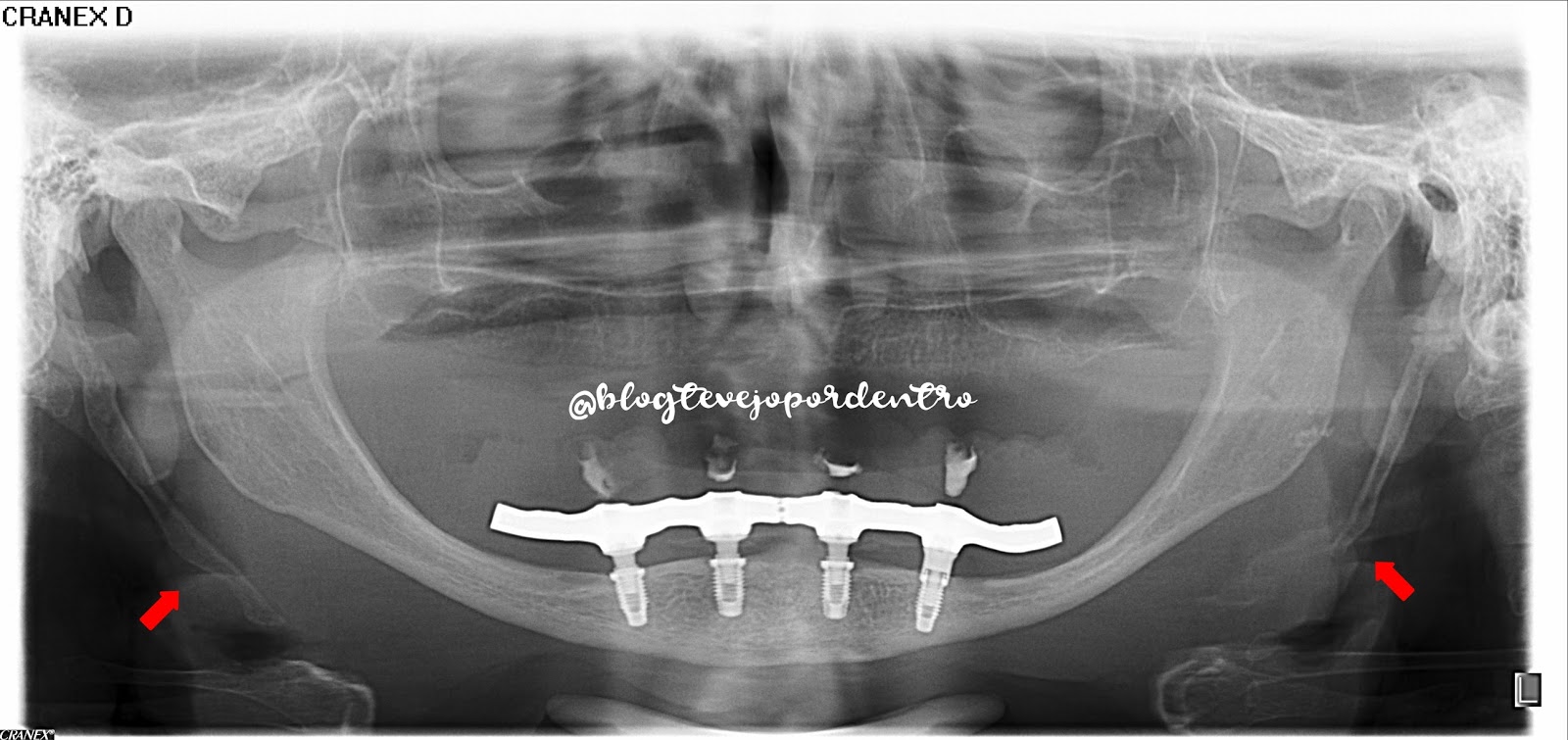 "Te vejo por dentro": Prolongamento e/ ou calcificação do processo ...