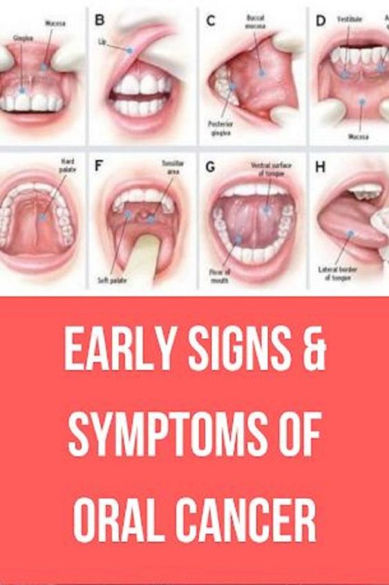 Oral Cancer Symptoms 7 Signs You Should Never Ignore Wellness True
