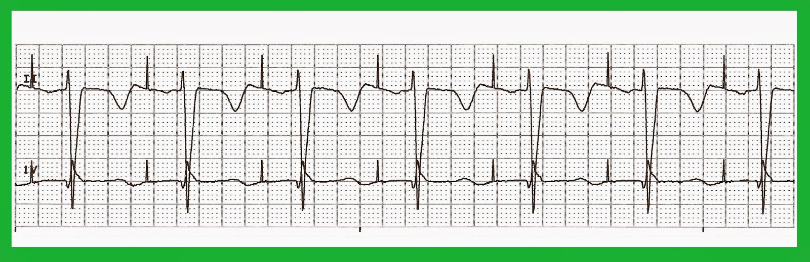 Practice EKG Strips 374