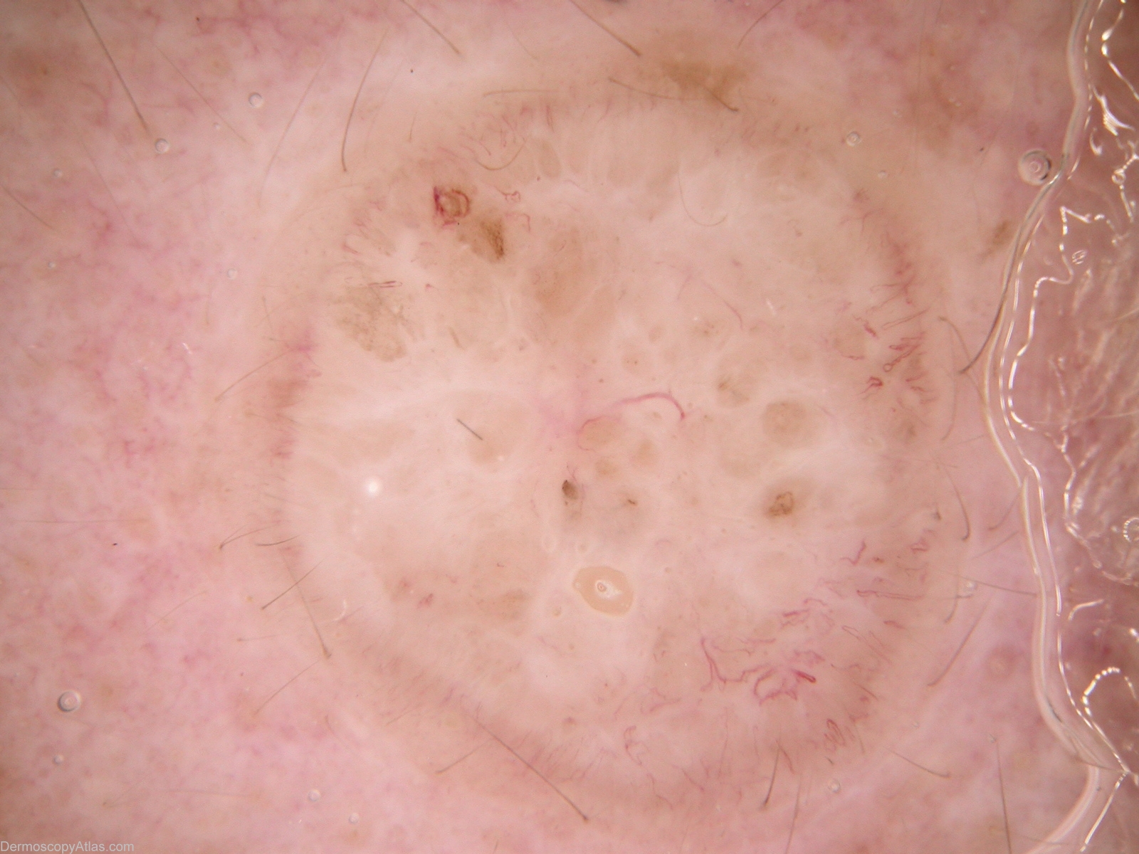 Dermoscopy Features as Clues: Clods Orange