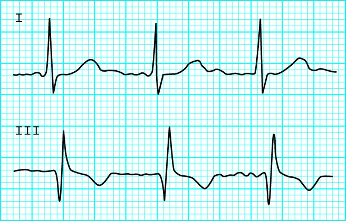 Pulmonary Embolism Patient- Clinical Scenario and Diagnosis-